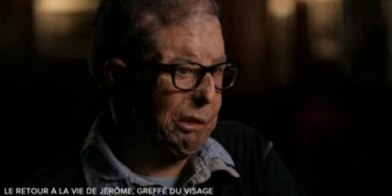 Le premier greffé total du visage sort du silence