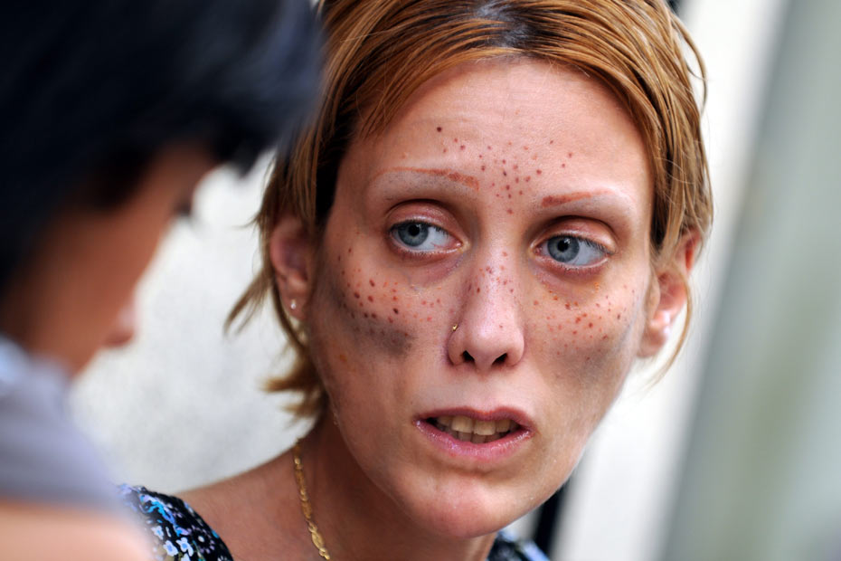 Anorexie : "Il est temps d'en parler"